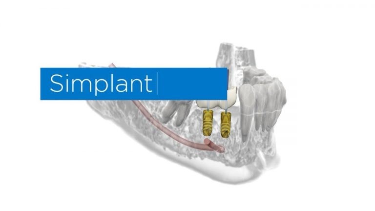 Simplant Pro 20 crack 2020 | dental software